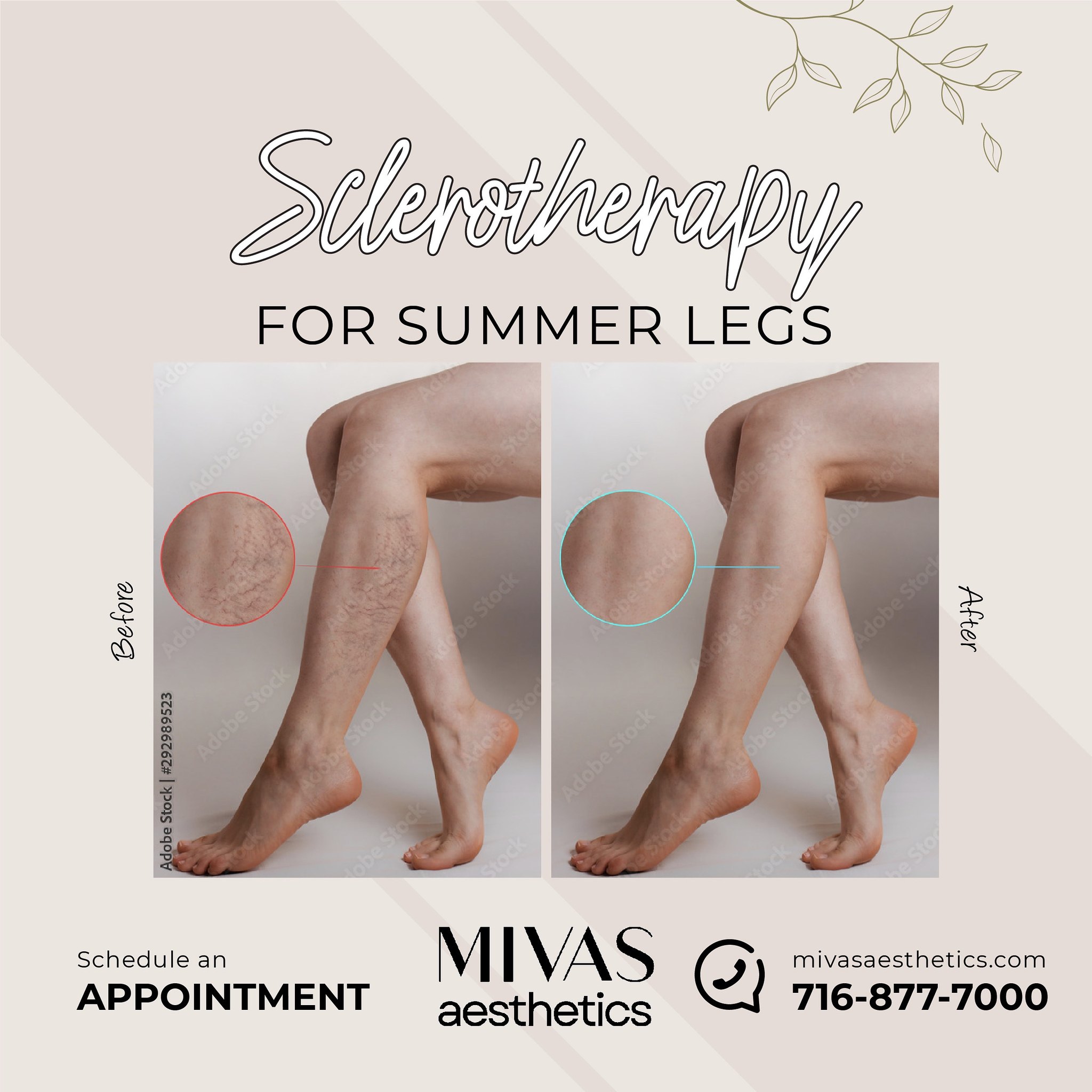 Put your best legs forward with sclerotherapy! - MIVAS aesthetics