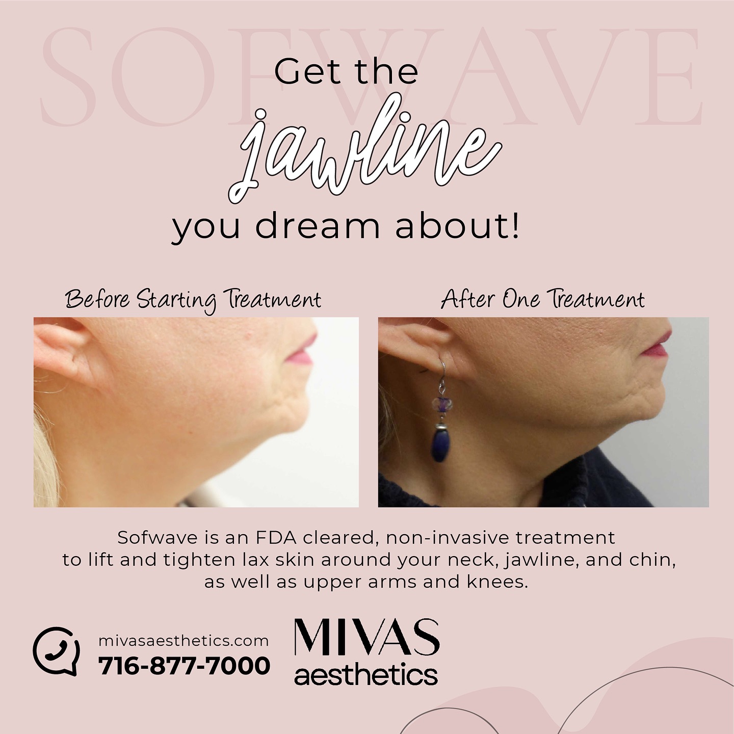 Get the Jawline You Dream About - MIVAS aesthetics